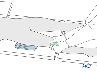 MIPO for Complete oblique or spiral, simple