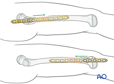 MIPO for Complete transverse, simple