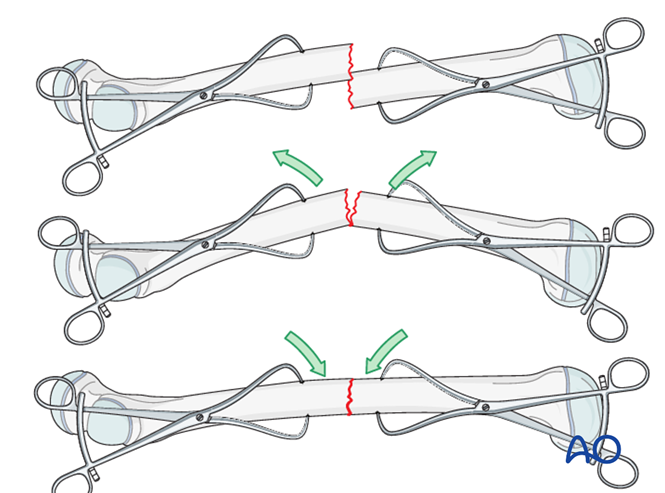 Open reduction; plate fixation for Complete transverse, simple