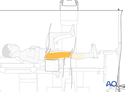 Patient preparation in supine position