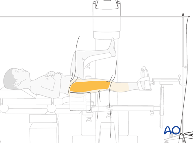 Patient preparation in supine position