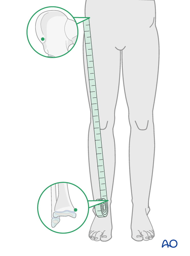 External fixation for Complete transverse, simple