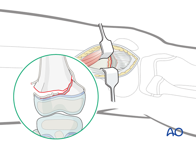 Lateral approach to the pediatric distal femur