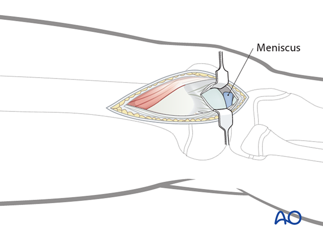 Lateral approach to the pediatric distal femur