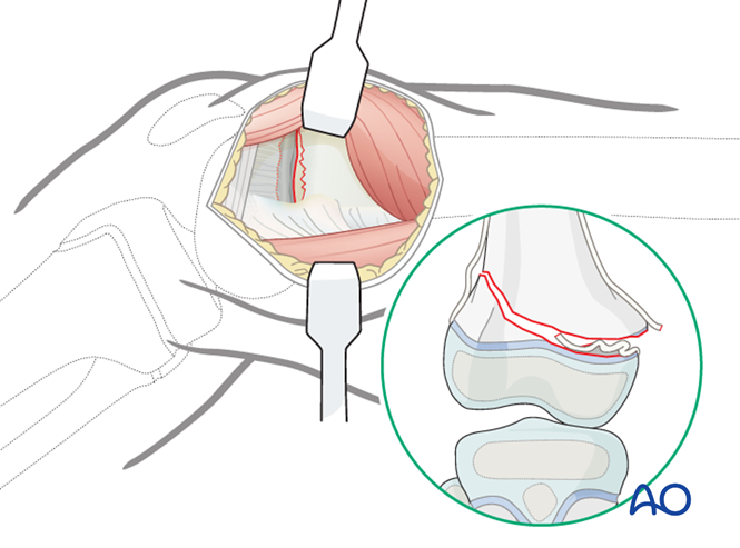 Medial approach to the pediatric distal femur