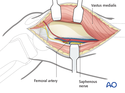 Medial approach to the pediatric distal femur