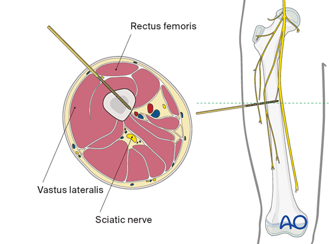 Safe zones for pin placement in the pediatric leg