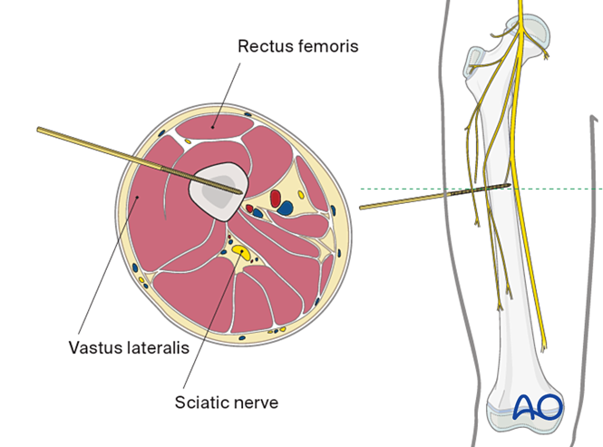 Safe zones for pin placement in the pediatric leg