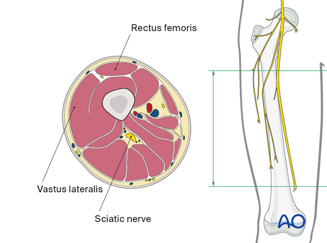 Safe zones for pin placement in the pediatric leg