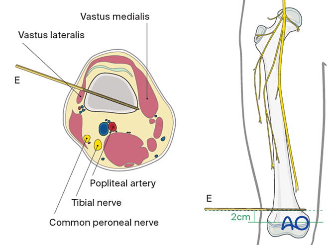 Safe zones for pin placement in the pediatric leg