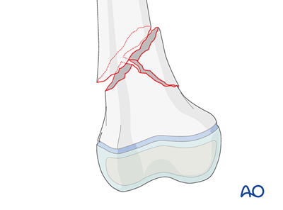 Metaphyseal, complete, multifragmentary