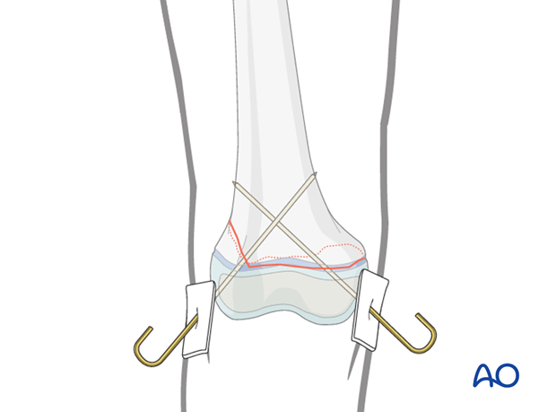 Closed Reduction K Wire Fixation Followed By Casting For