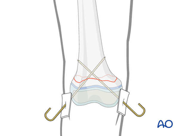 Closed Reduction K Wire Fixation Followed By Casting For Metaphyseal