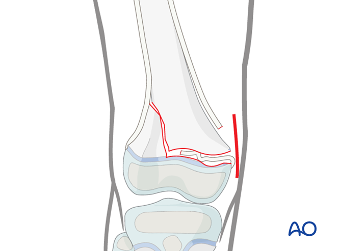 Percutaneous/open reduction; screw fixation for Epiphysiolysis with ...
