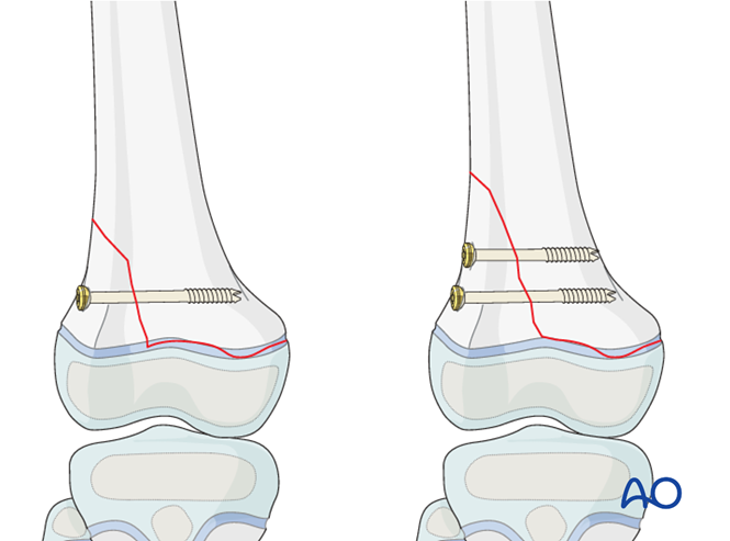 Percutaneous/open reduction; screw fixation for Epiphysiolysis with ...
