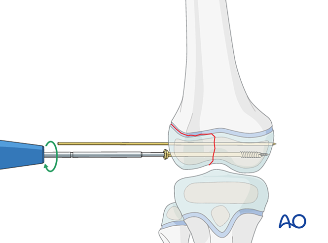 Reduction And Screw Fixation With Arthroscopic Assistance For