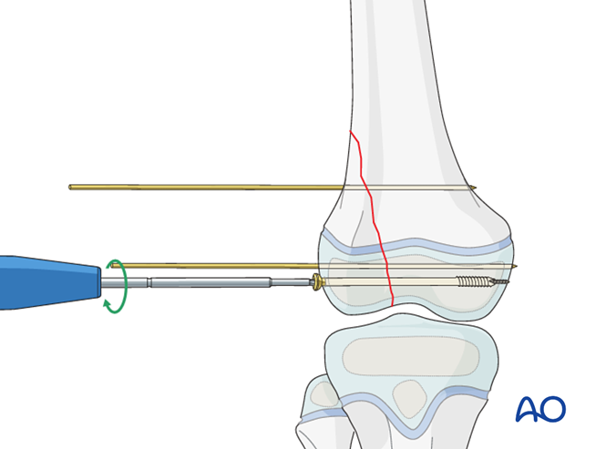 Open reduction; screw fixation for Epi-/metaphyseal, Salter-Harris IV ...