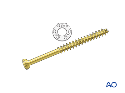 Open reduction; screw fixation for Metaphyseal, avulsion