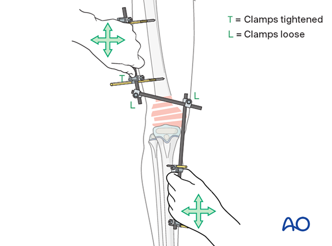 External fixation for Metaphyseal, complete, multifragmentary