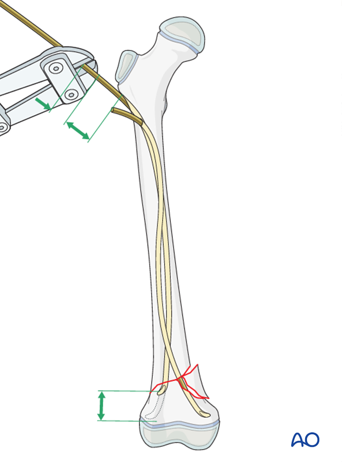 ESIN (antegrade) for Metaphyseal, complete, multifragmentary