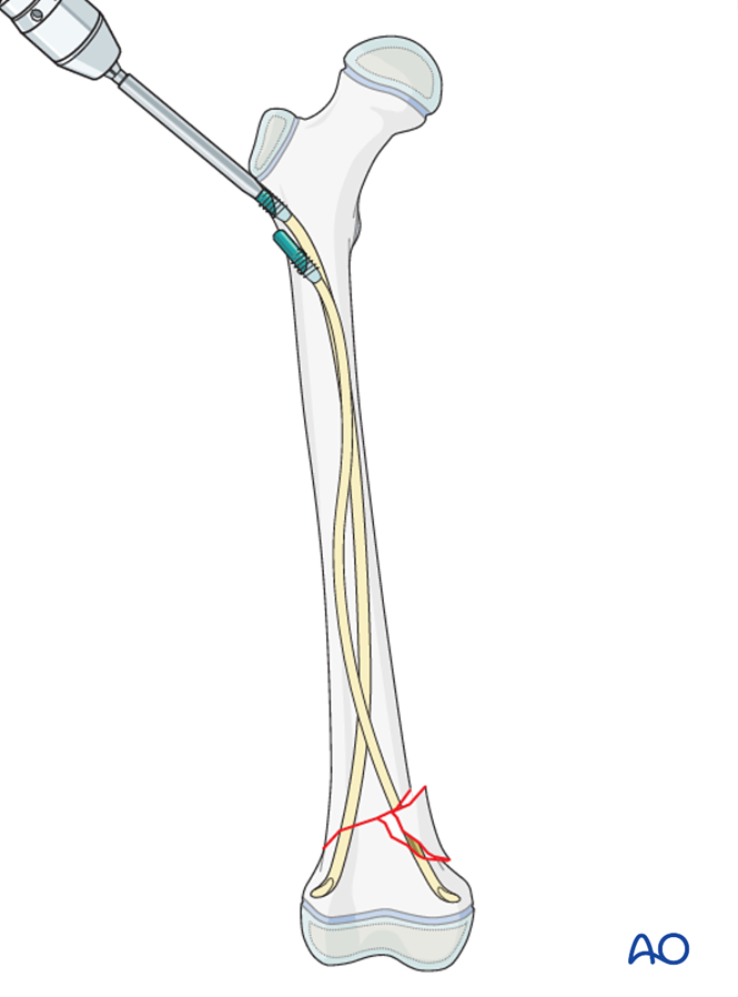 ESIN (antegrade) for Metaphyseal, complete, multifragmentary