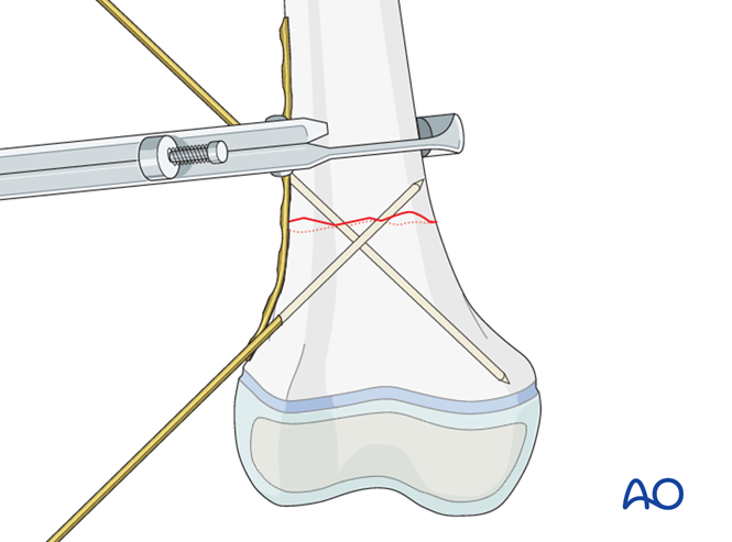 Open reduction; plate fixation for Metaphyseal, complete, simple