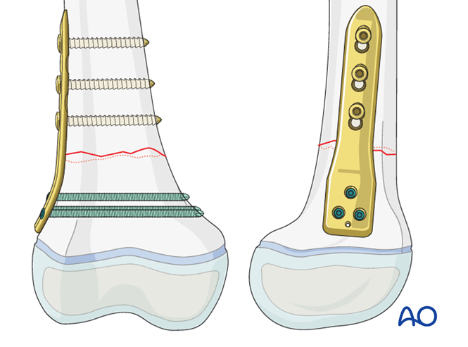 Open reduction; plate fixation for Metaphyseal, complete, simple
