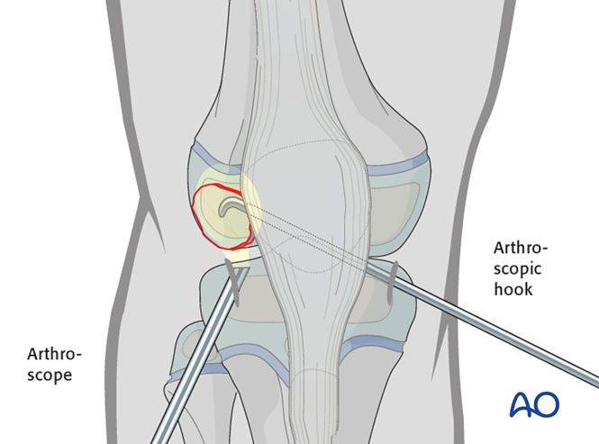 Open reduction; pin or screw fixation for Intraarticular flake