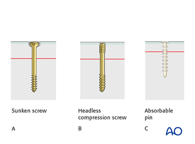 Open reduction; pin or screw fixation for Intraarticular flake