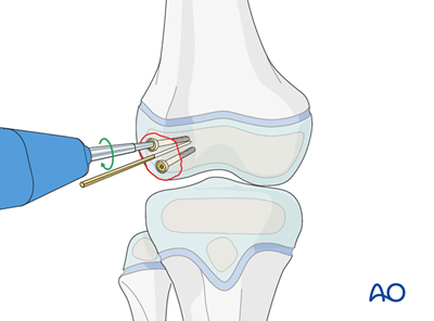 Open reduction; pin or screw fixation for Intraarticular flake