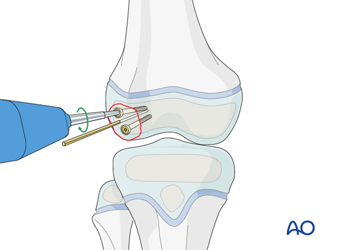 Open reduction; pin or screw fixation for Intraarticular flake