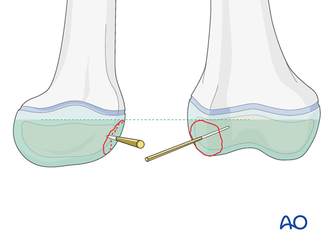 Open reduction; pin or screw fixation for Intraarticular flake