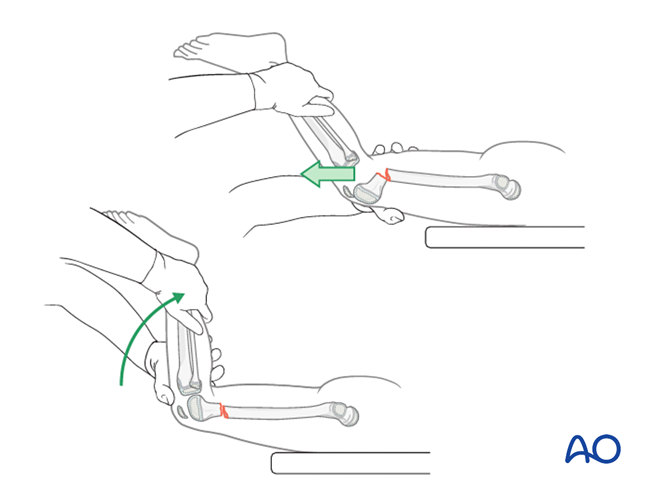 Closed reduction; K-wire fixation followed by casting for Metaphyseal ...