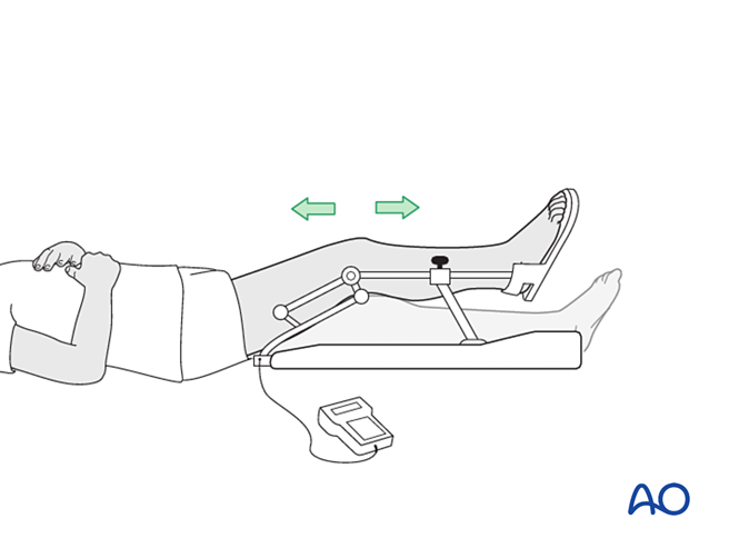 Open reduction; pin or screw fixation for Intraarticular flake