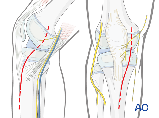 All approaches to the pediatric proximal tibia