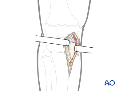 Medial parapatellar approach to the proximal tibia