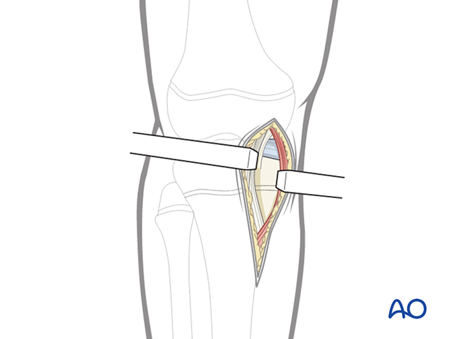 Medial parapatellar approach to the proximal tibia