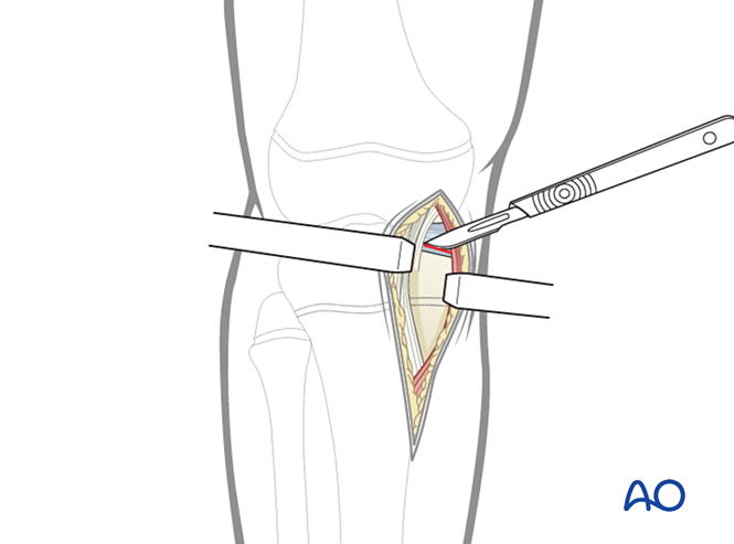 Medial parapatellar approach to the proximal tibia