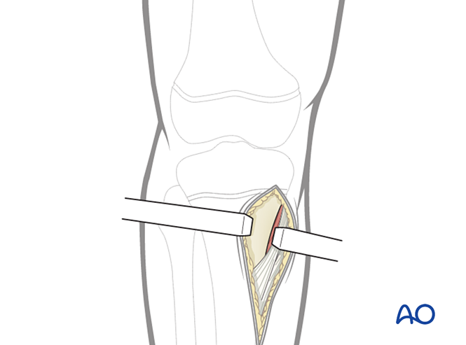 Medial parapatellar approach to the proximal tibia