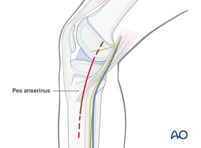 All approaches to the pediatric proximal tibia