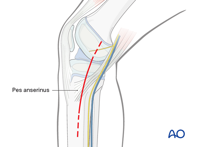 All approaches to the pediatric proximal tibia