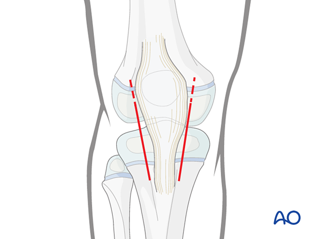 All approaches to the pediatric proximal tibia