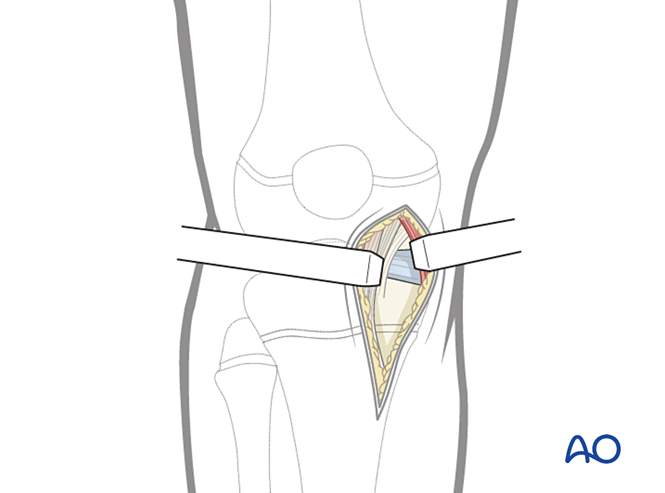 Suture fixation for Avulsion of the tibial spine