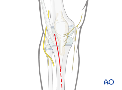 Anterolateral approach to the proximal tibia