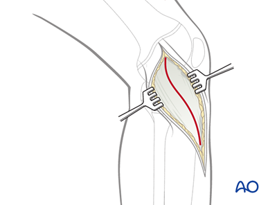 Anterolateral approach to the proximal tibia