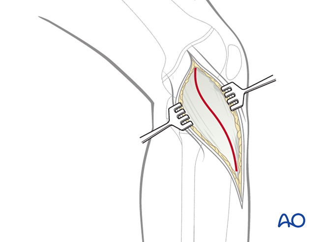 Anterolateral approach to the proximal tibia