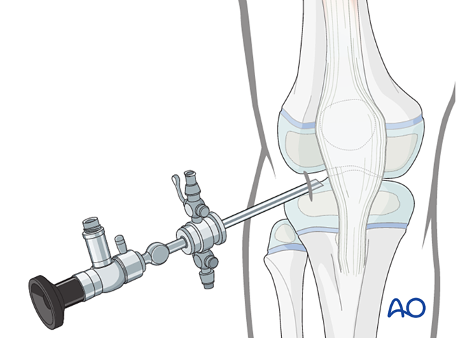Arthroscopic approach to the pediatric knee