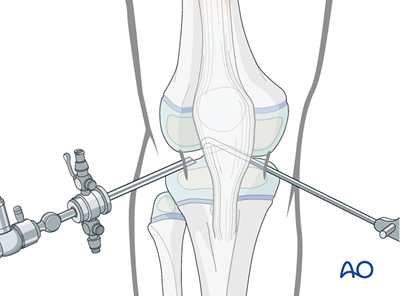 Arthroscopically assisted screw fixation for Avulsion of the tibial spine