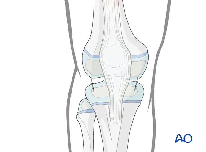 Arthroscopic approach to the pediatric knee