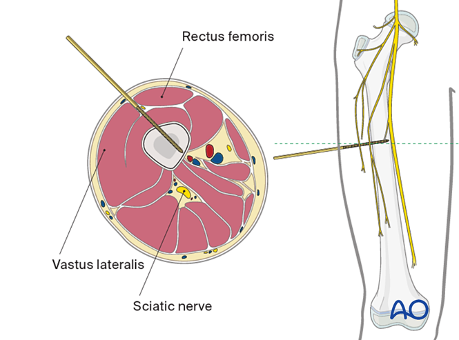 Safe zones for pin placement in the pediatric thigh and leg